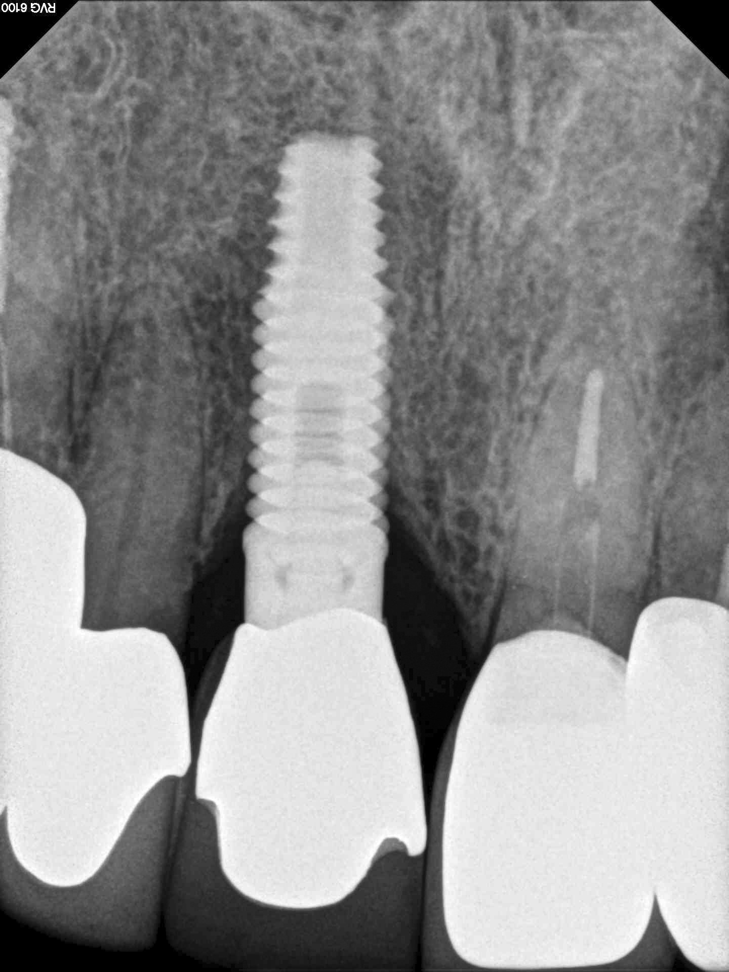 Dental News - Guided applications for partial extraction therapy
