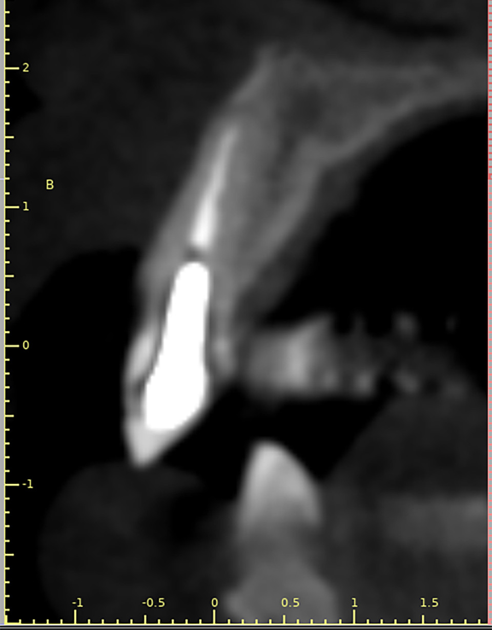 Use of a decalcified cortical bone plate to aid in lateral ridge ...