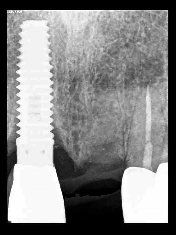 Dental News - Guided applications for partial extraction therapy