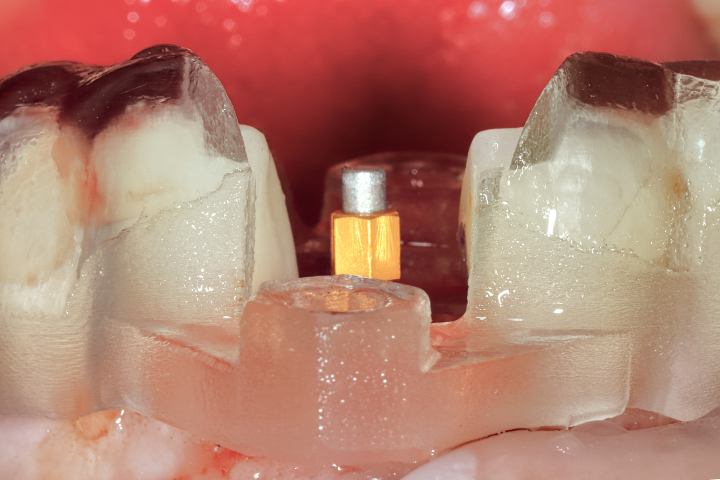 Dental News - Guided applications for partial extraction therapy