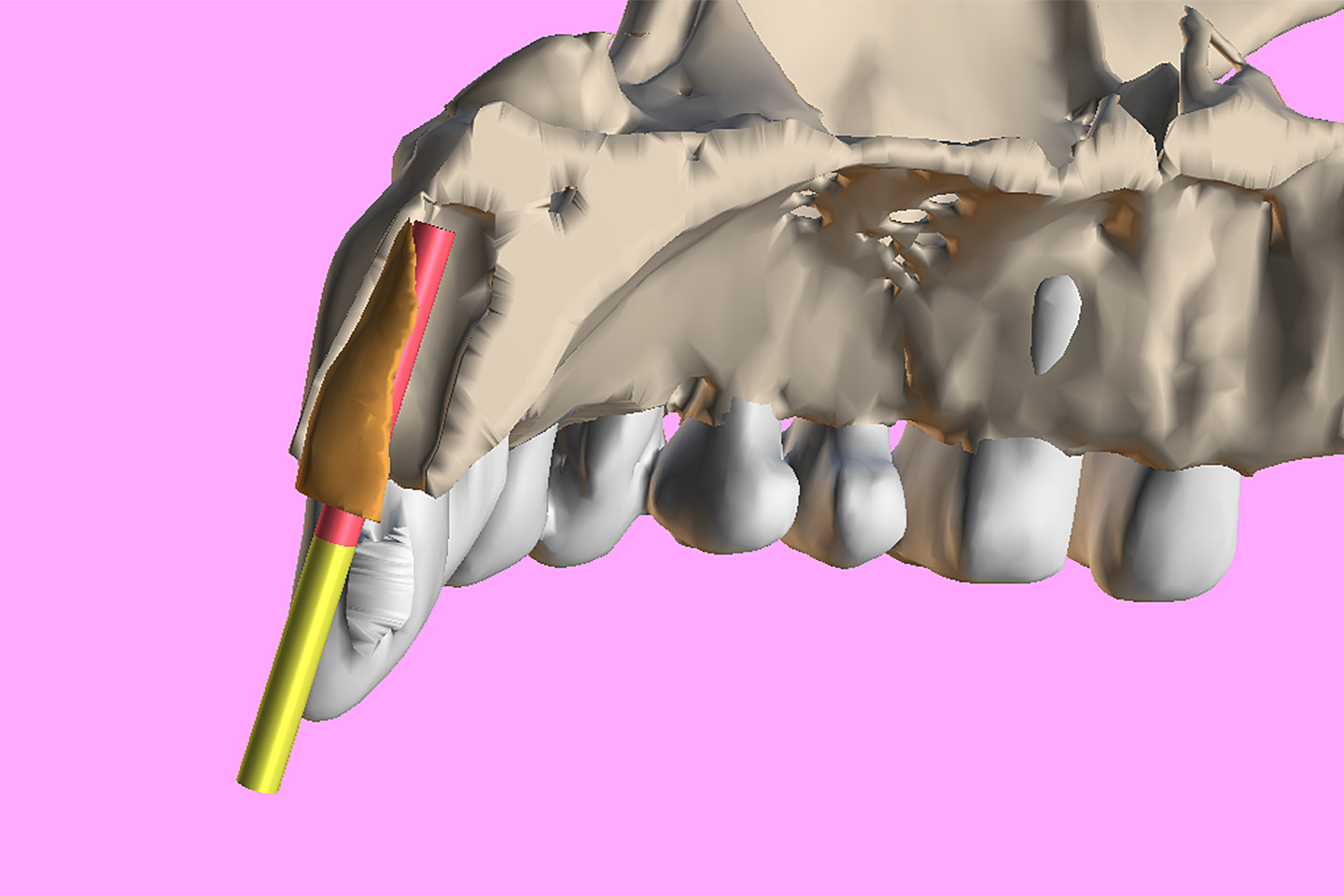 Dental News - Guided applications for partial extraction therapy