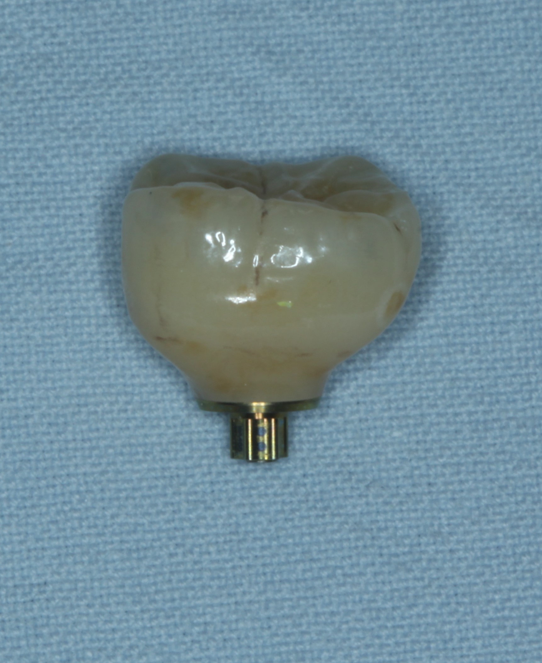 Immediate placement and loading of Straumann TLX