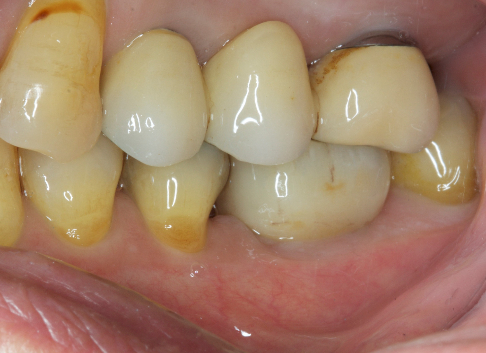Immediate placement and loading of Straumann TLX