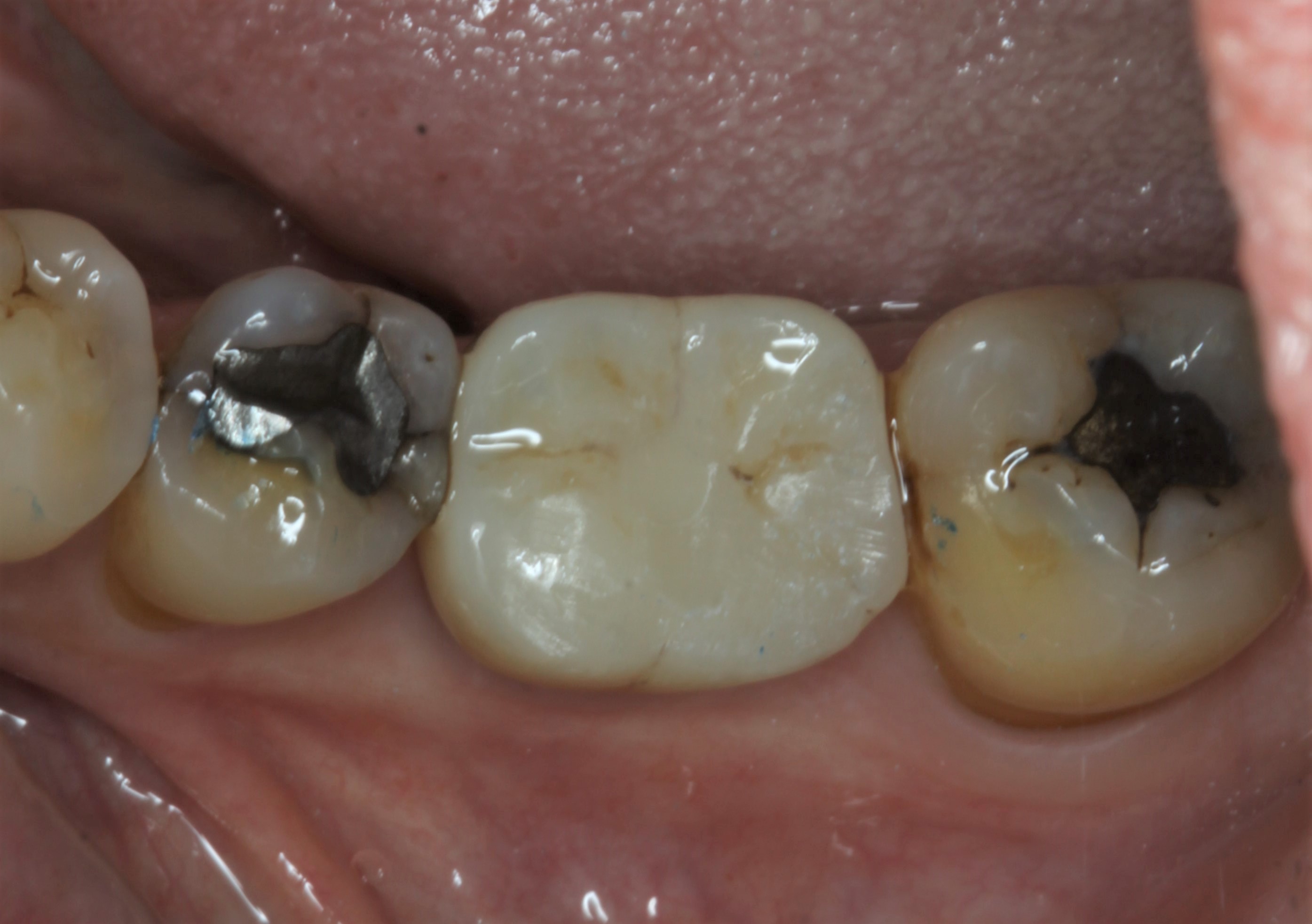 Immediate placement and loading of Straumann TLX