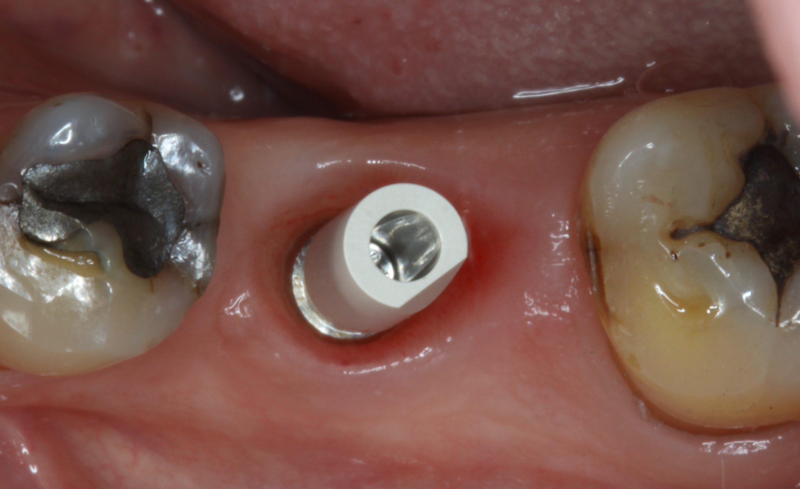 Immediate placement and loading of Straumann TLX