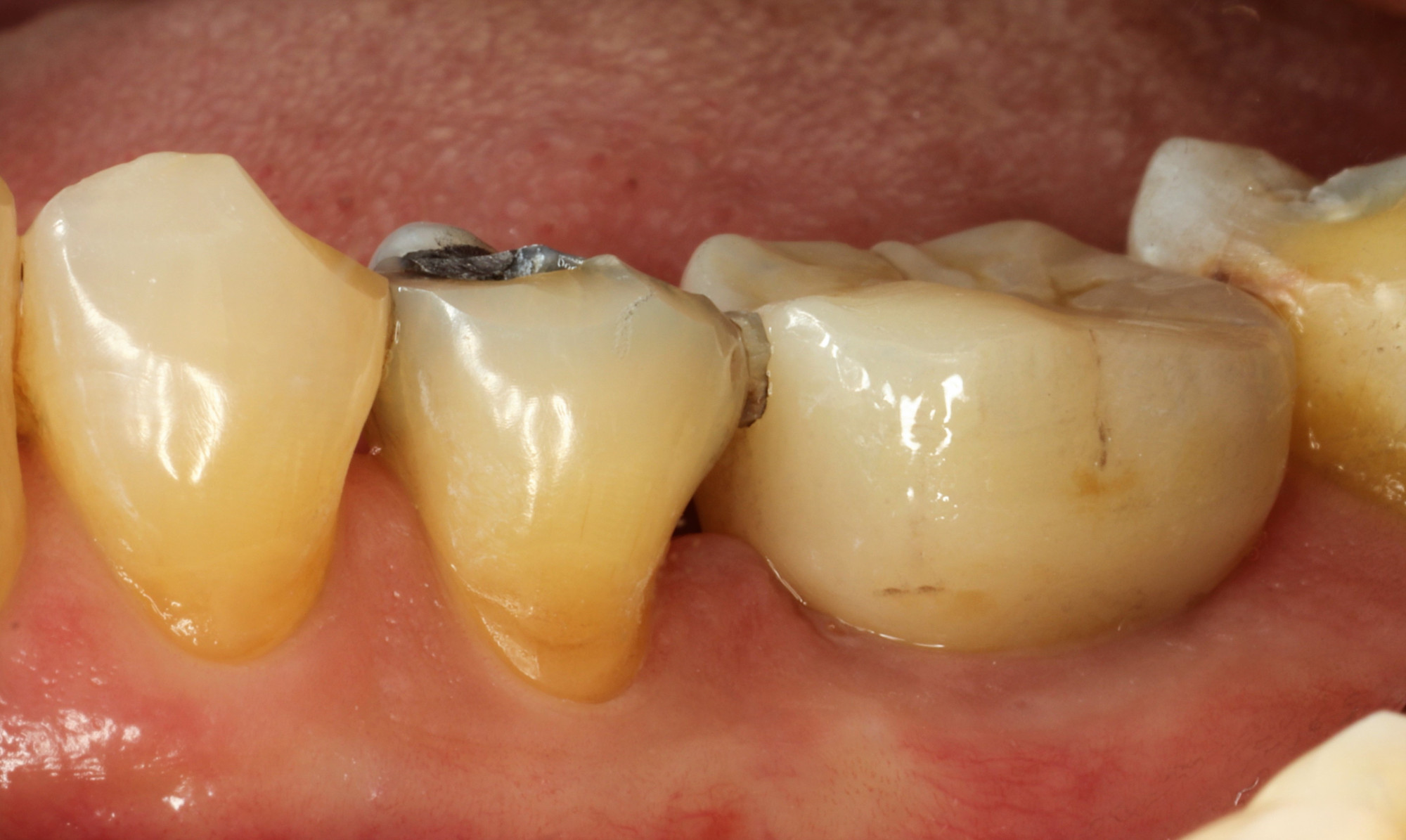 Immediate placement and loading of Straumann TLX