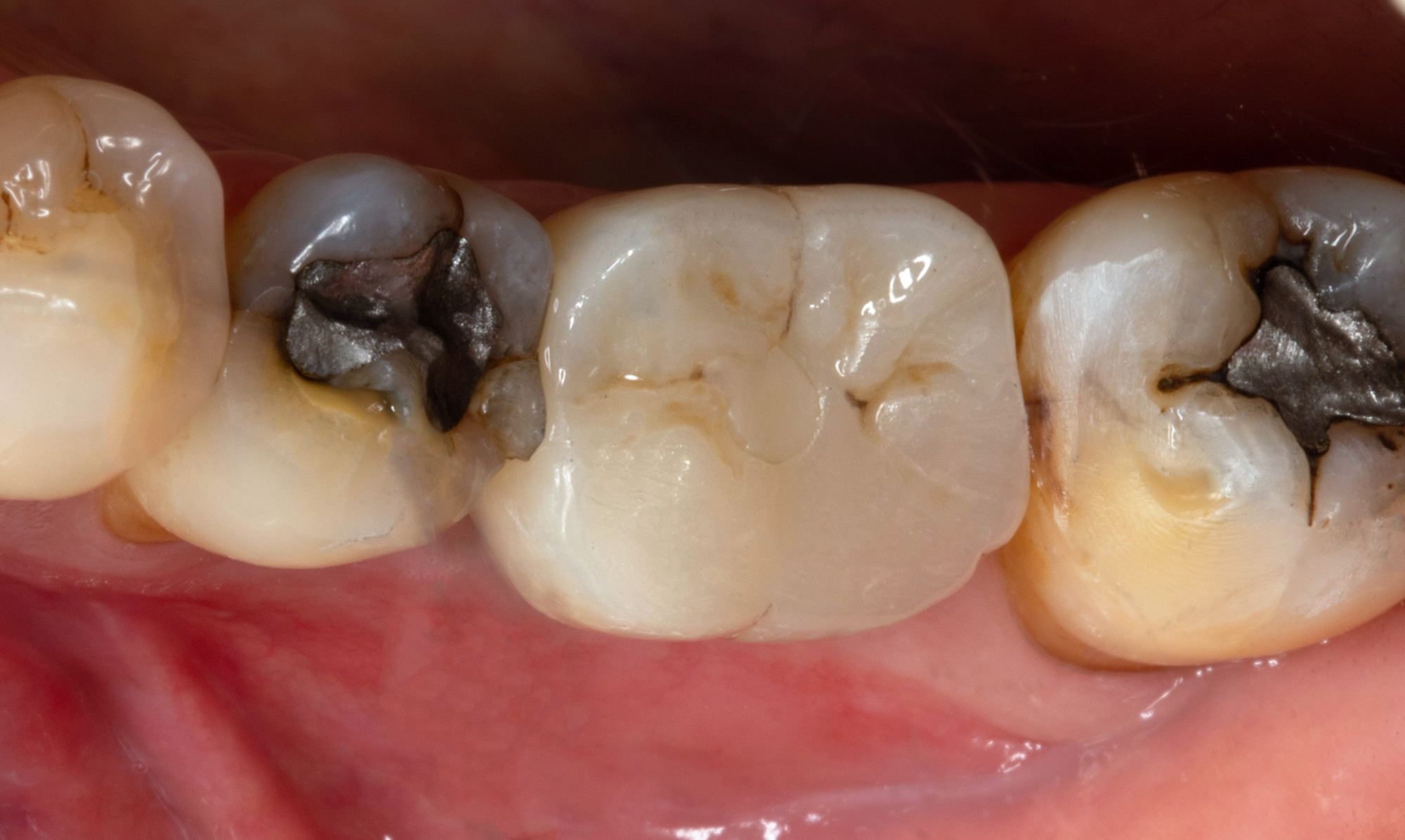 Immediate placement and loading of Straumann TLX