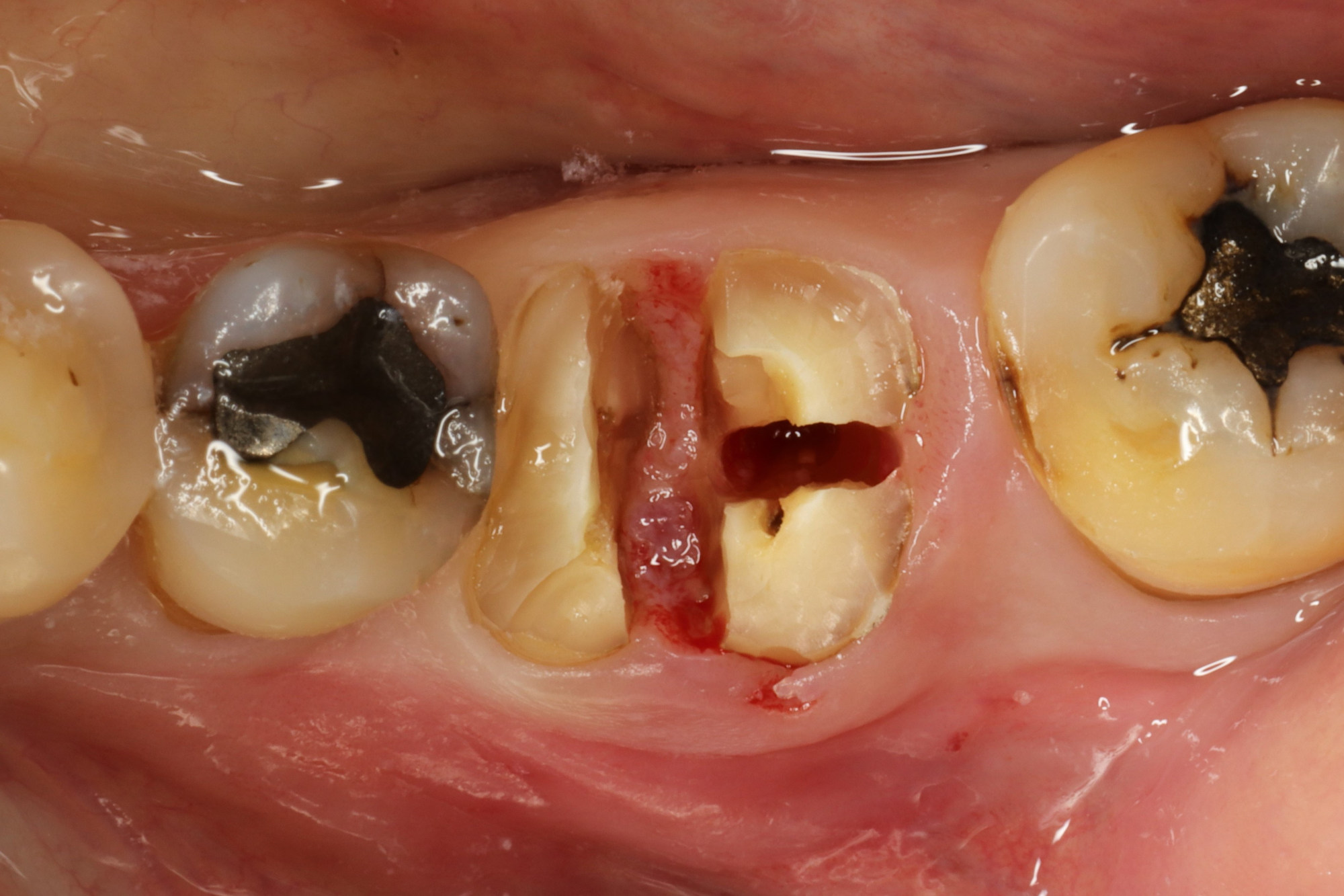 Immediate placement and loading of Straumann TLX