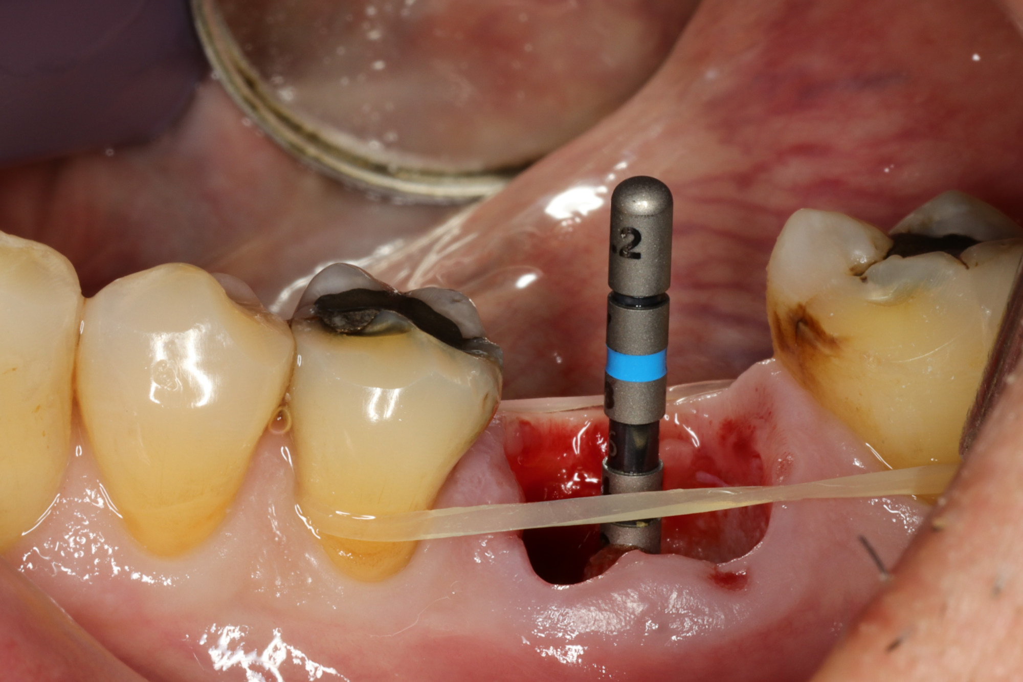 Immediate placement and loading of Straumann TLX
