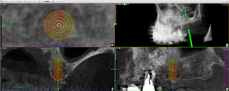 DT News - MEA - CBCT bone-densitometry for pre-surgical decision-making