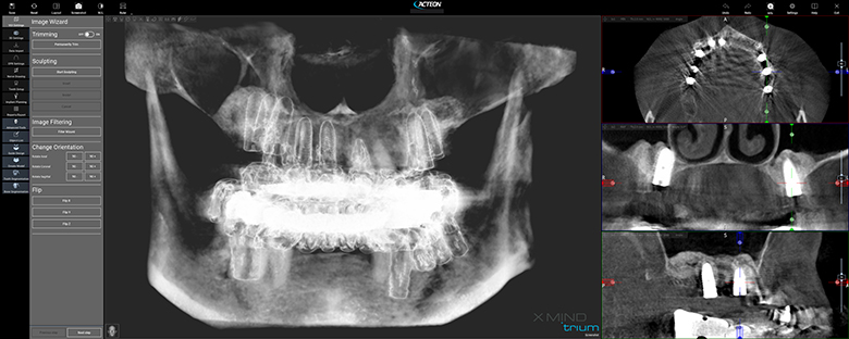 DT News - MEA - CBCT bone-densitometry for pre-surgical decision-making
