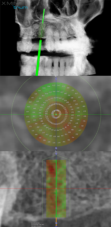 DT News - MEA - CBCT bone-densitometry for pre-surgical decision-making