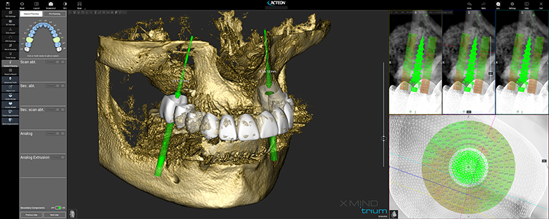 DT News - MEA - CBCT bone-densitometry for pre-surgical decision-making