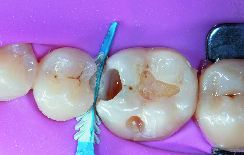 DT News - MEA - Simplified protocol for adjacent Class II direct resin ...