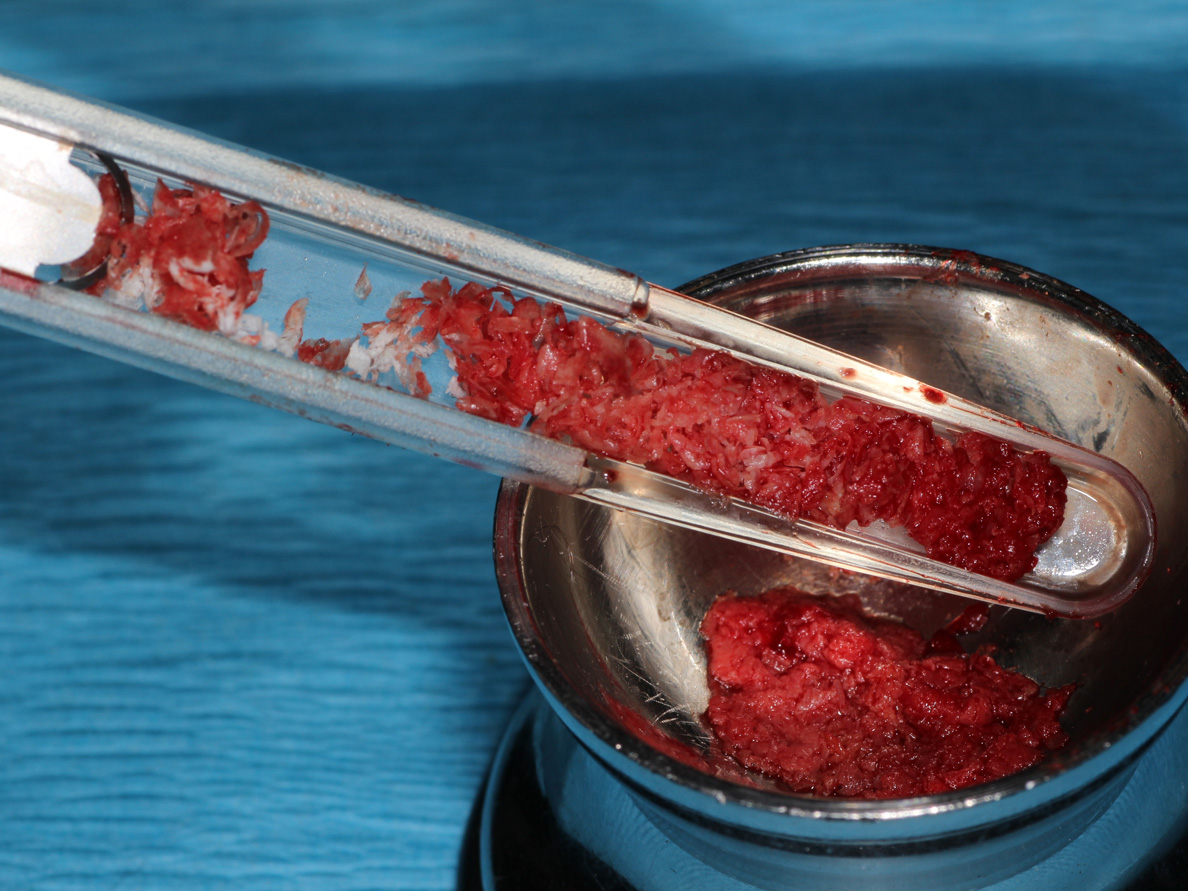 Dental News - Use of a decalcified cortical bone plate to aid in ...