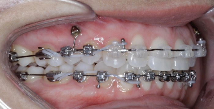 Dental News - New Age orthodontics and orthopaedics with temporary ...