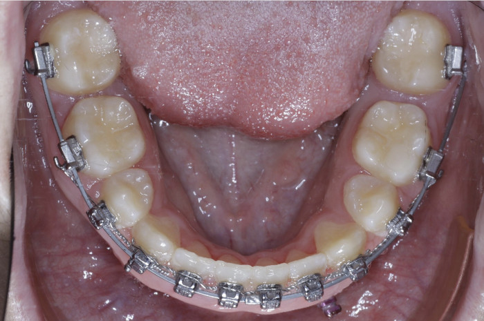 New Age orthodontics and orthopaedics with temporary anchorage devices
