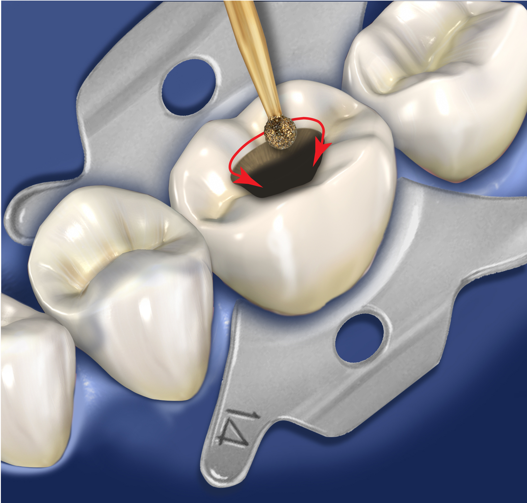Eliminating the challenges of crown removal or endodontic access ...