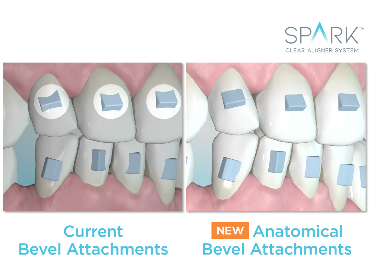 Ormco announces FDA approval to treat mixed dentition with Spark clear aligners