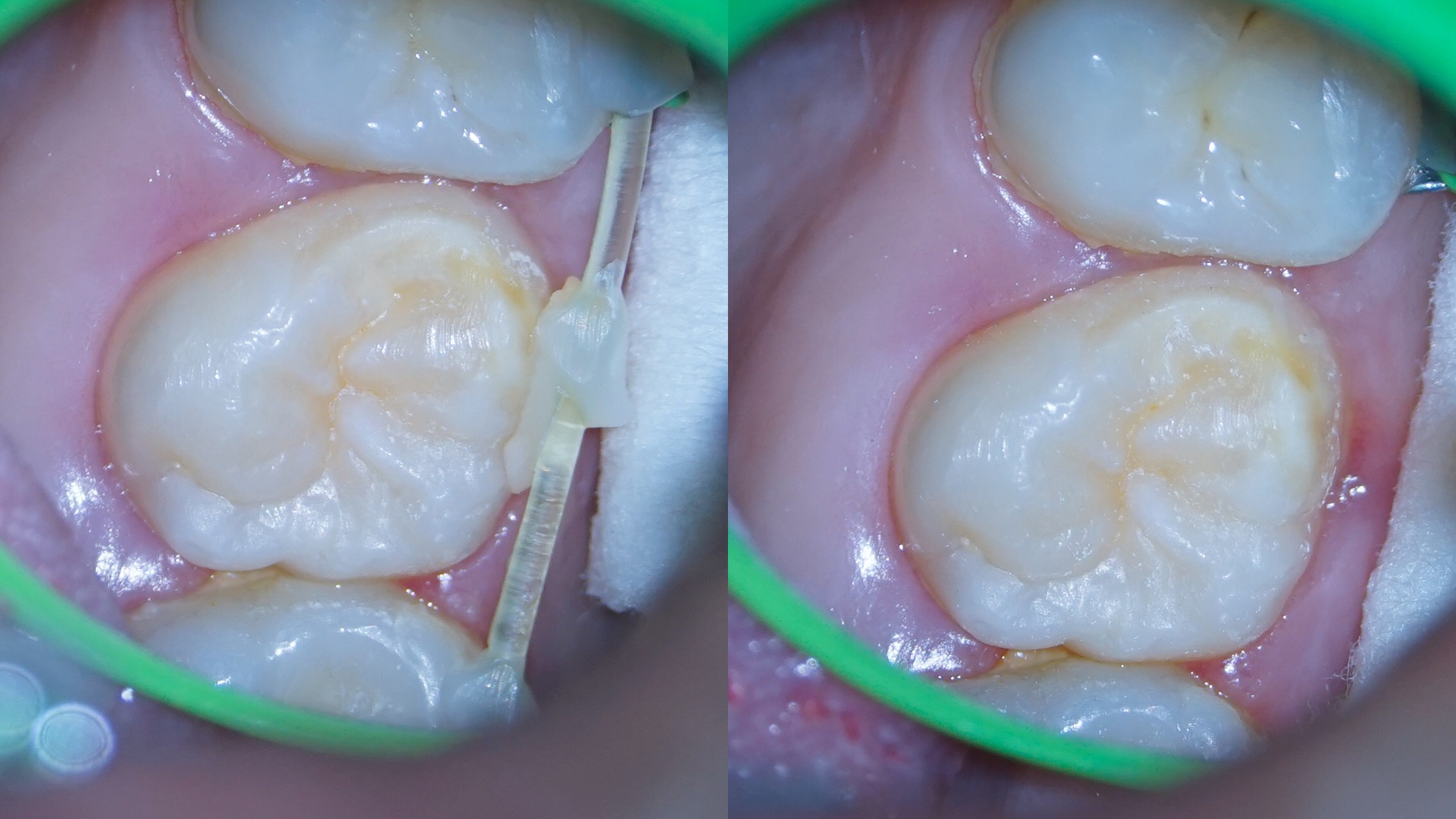 Dental News - Autogenous transplantation followed by conservative root ...
