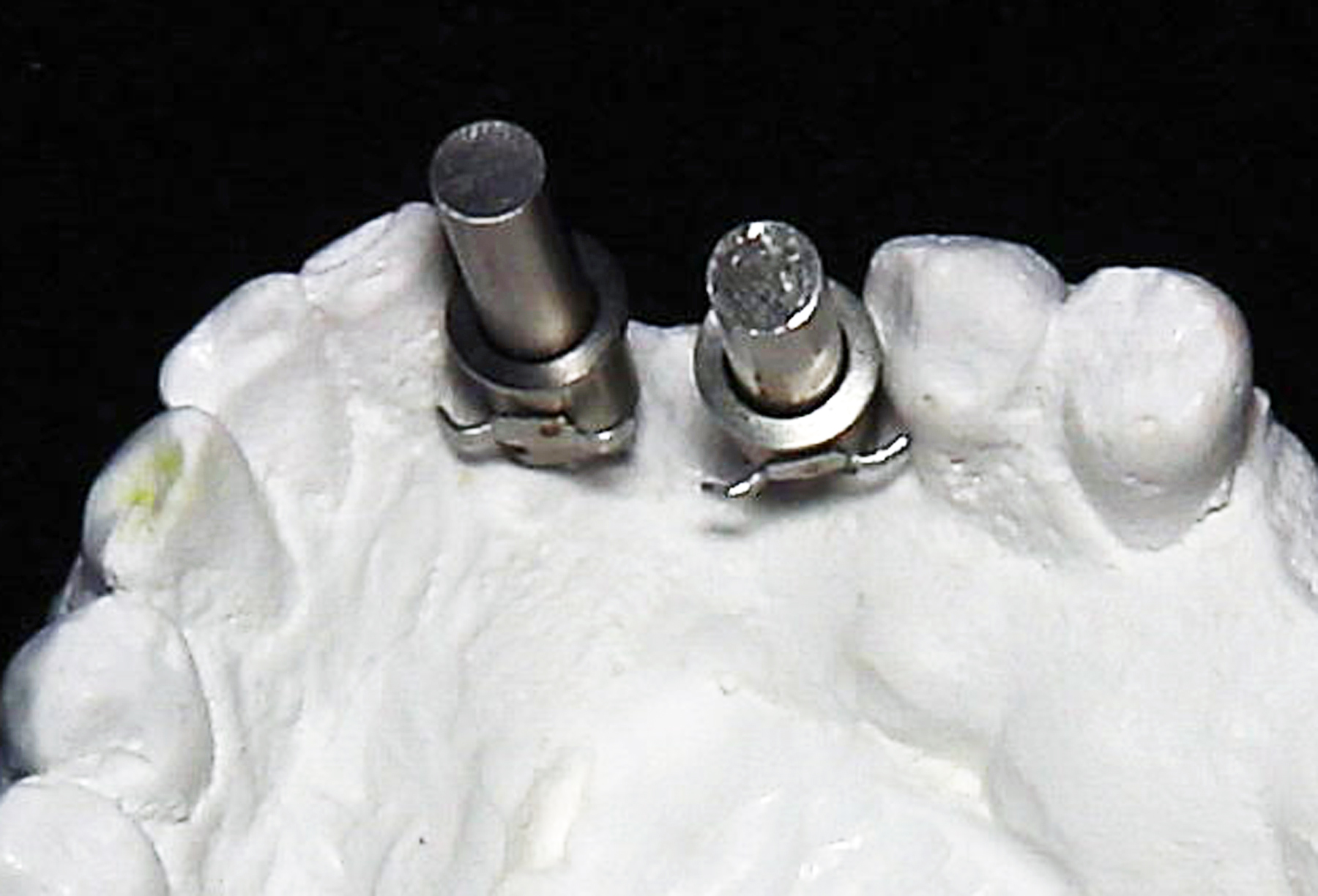 Dental News - An in-office-fabricated implant surgical guide corrected ...