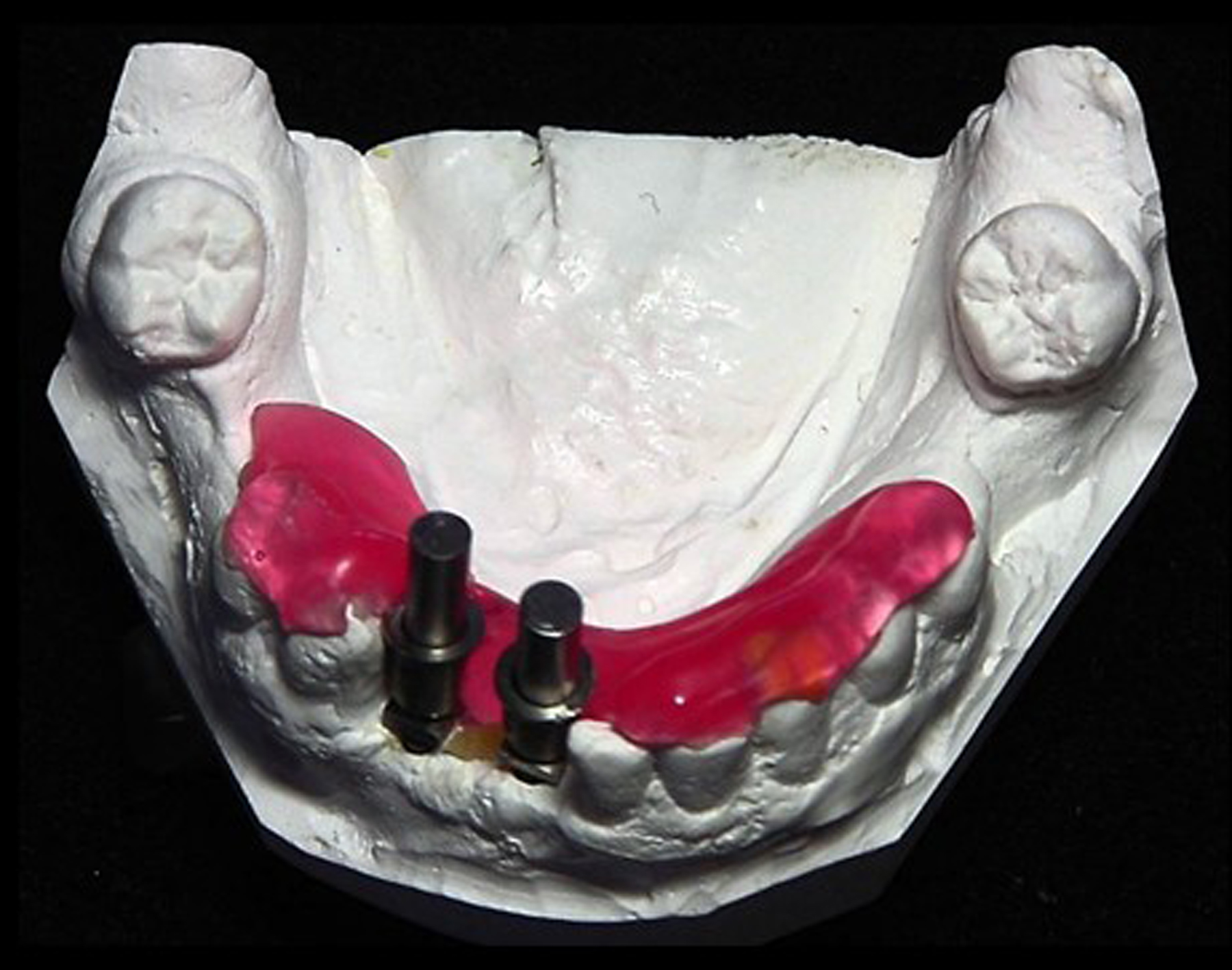 Dental News - An in-office-fabricated implant surgical guide corrected ...