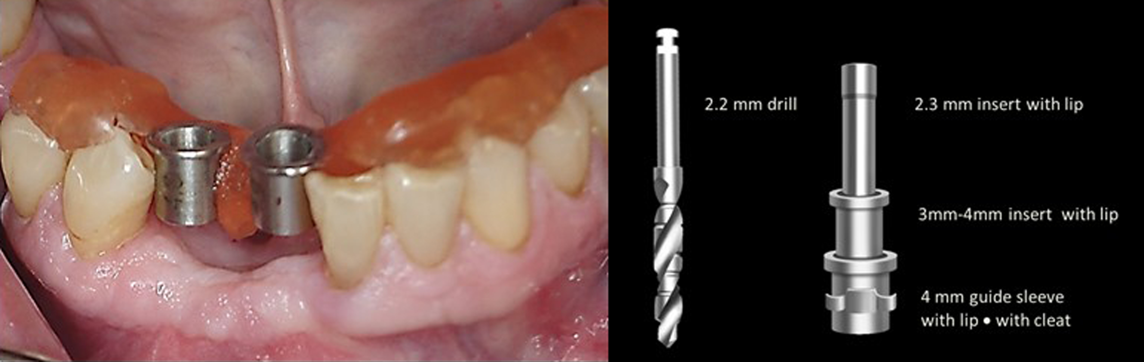 Dental News - An in-office-fabricated implant surgical guide corrected ...