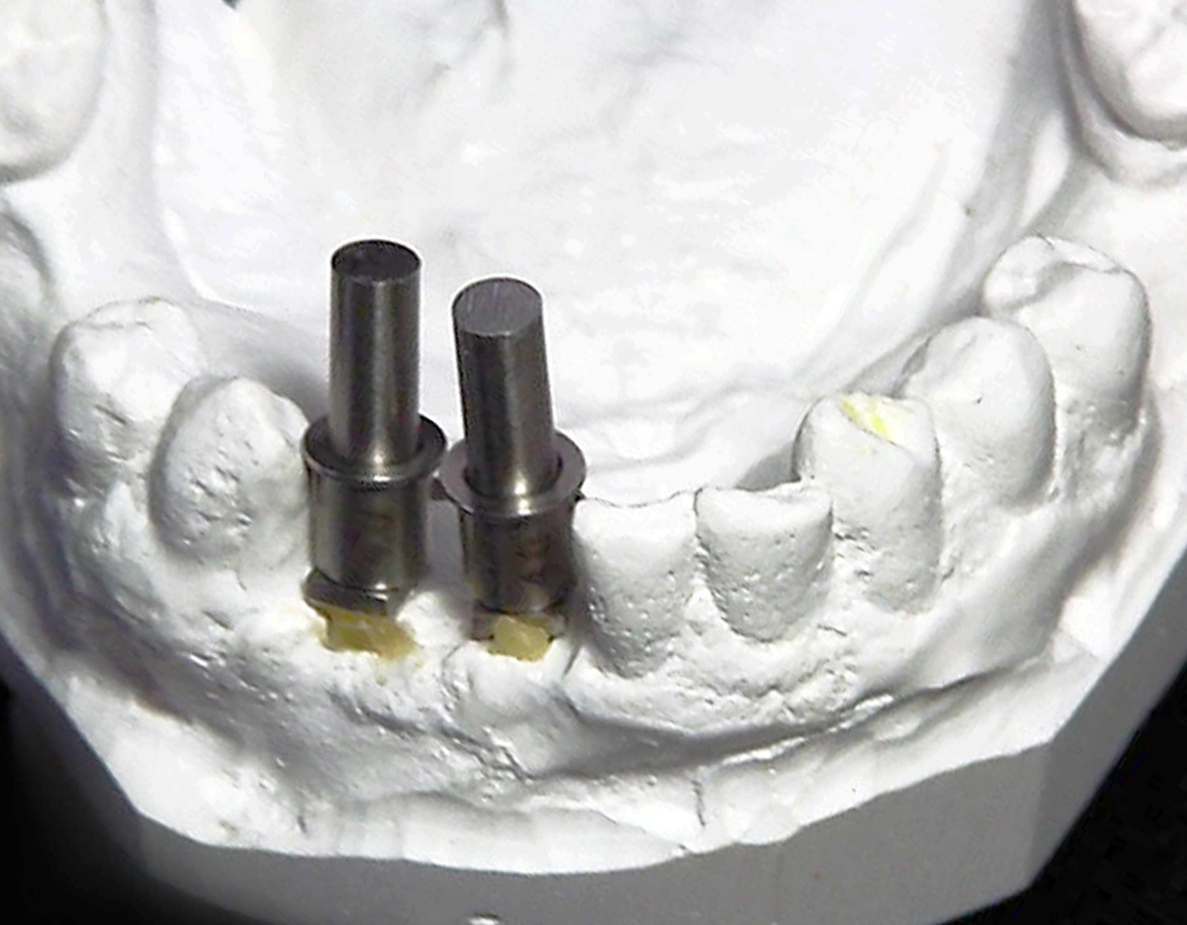 Dental News - An in-office-fabricated implant surgical guide corrected ...