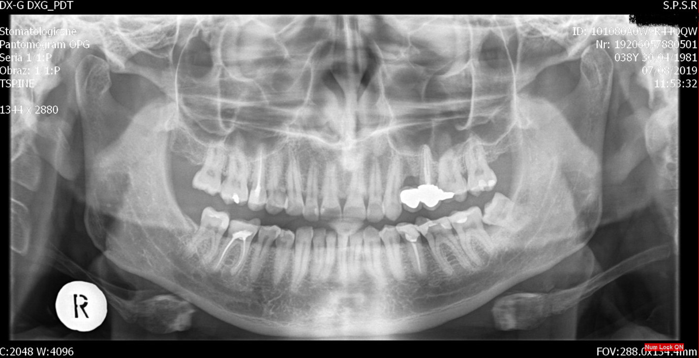 Endodontic treatment of maxillary left first molar