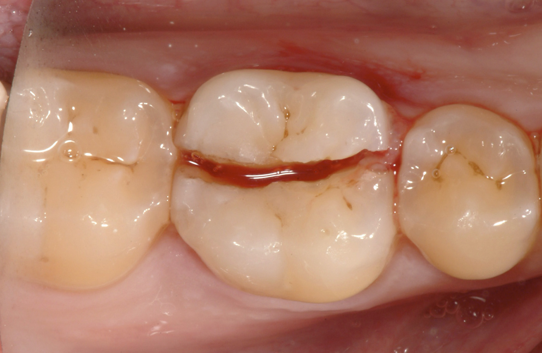 Dental News - Achieving anatomical shape, support and colour with an ...