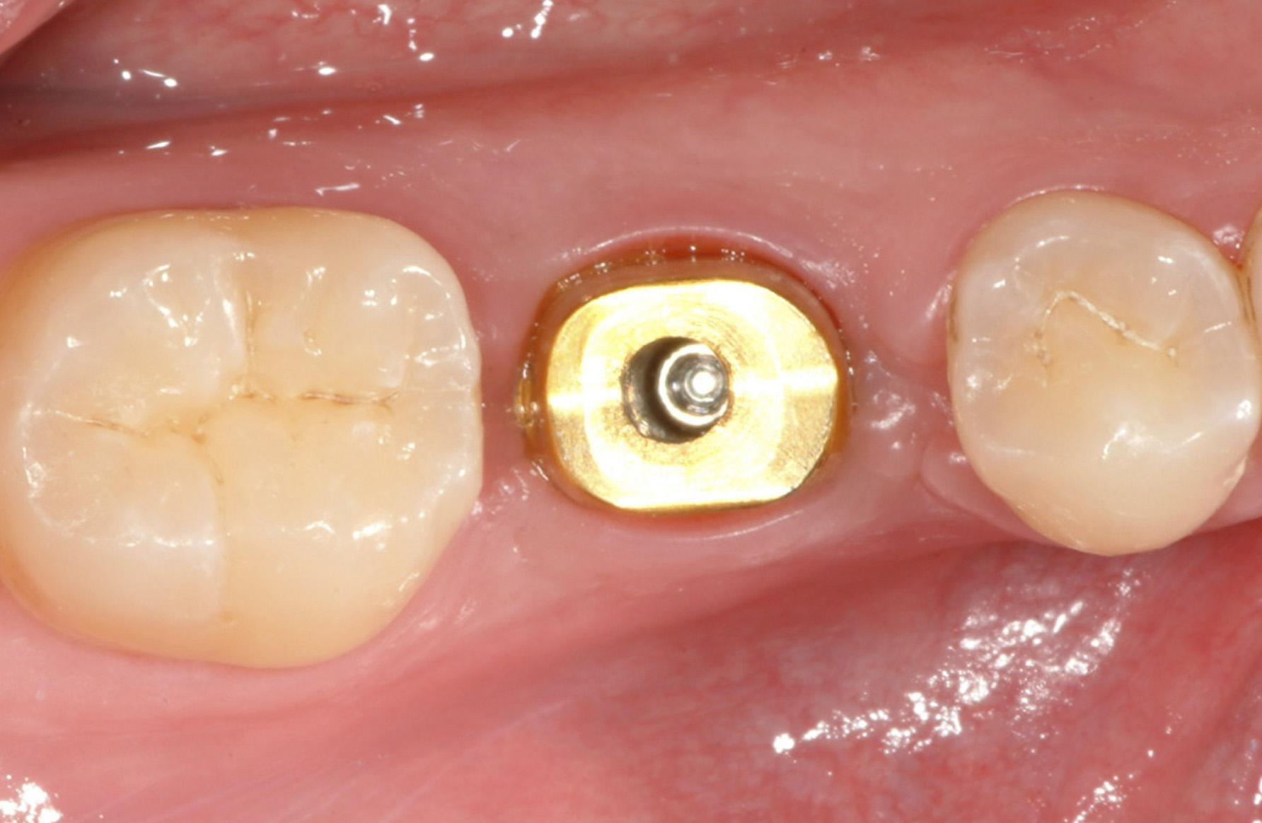 Dental News - Achieving anatomical shape, support and colour with an ...