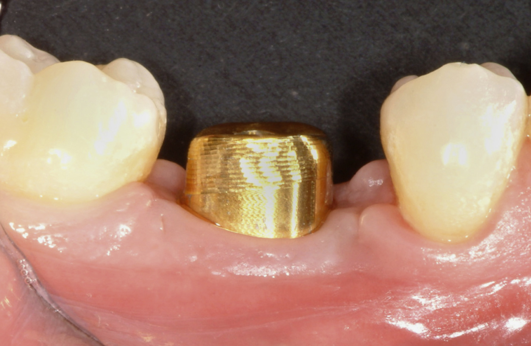 Dental News - Achieving anatomical shape, support and colour with an ...