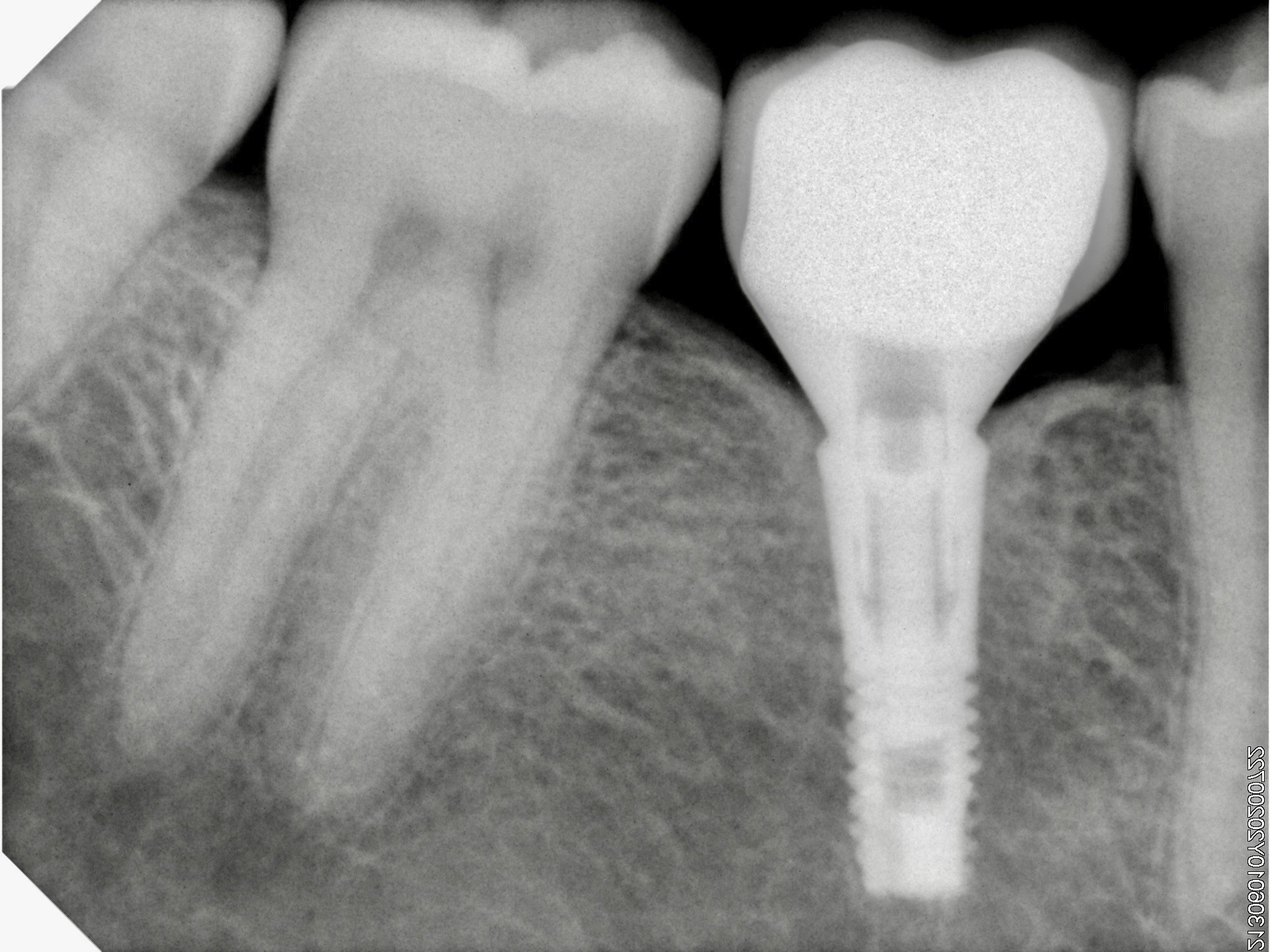 Dental News - Achieving anatomical shape, support and colour with an ...