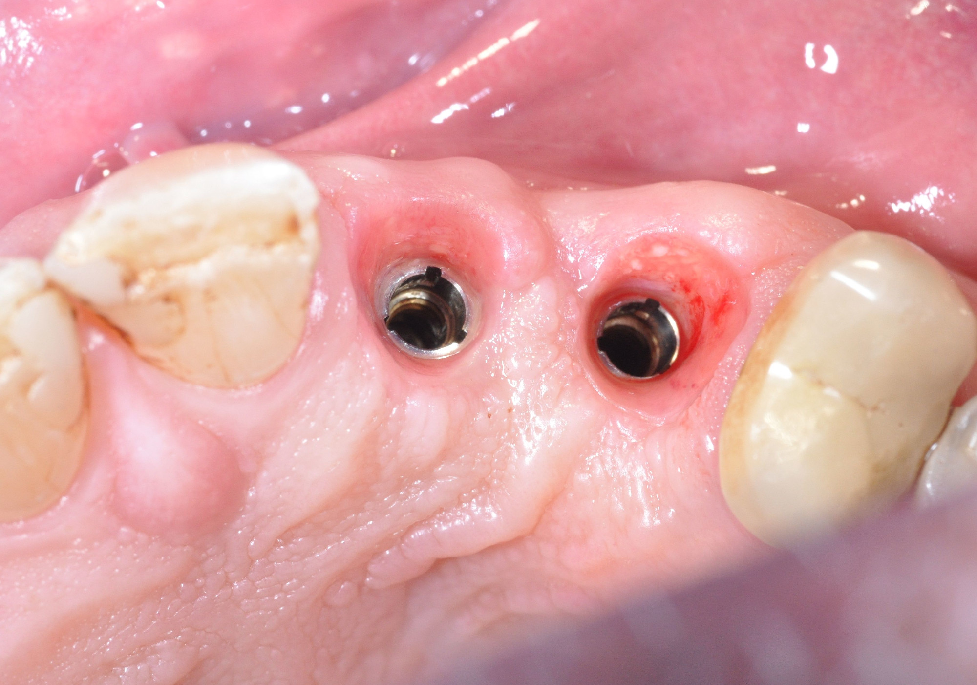 Periodontitis and peri-implantitis in implant dentistry