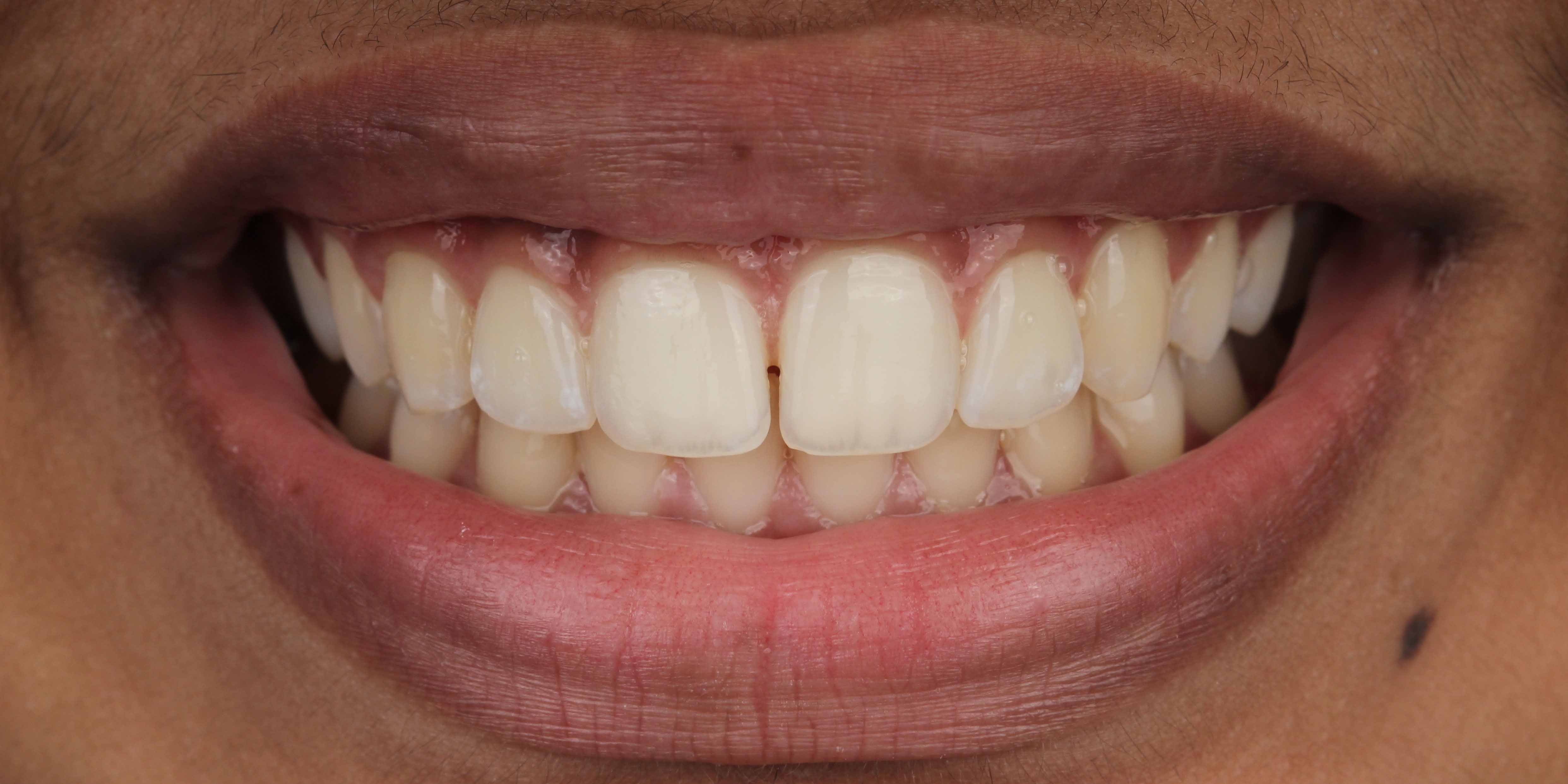 DT News - India - Front wing technique for direct diastema closures ...