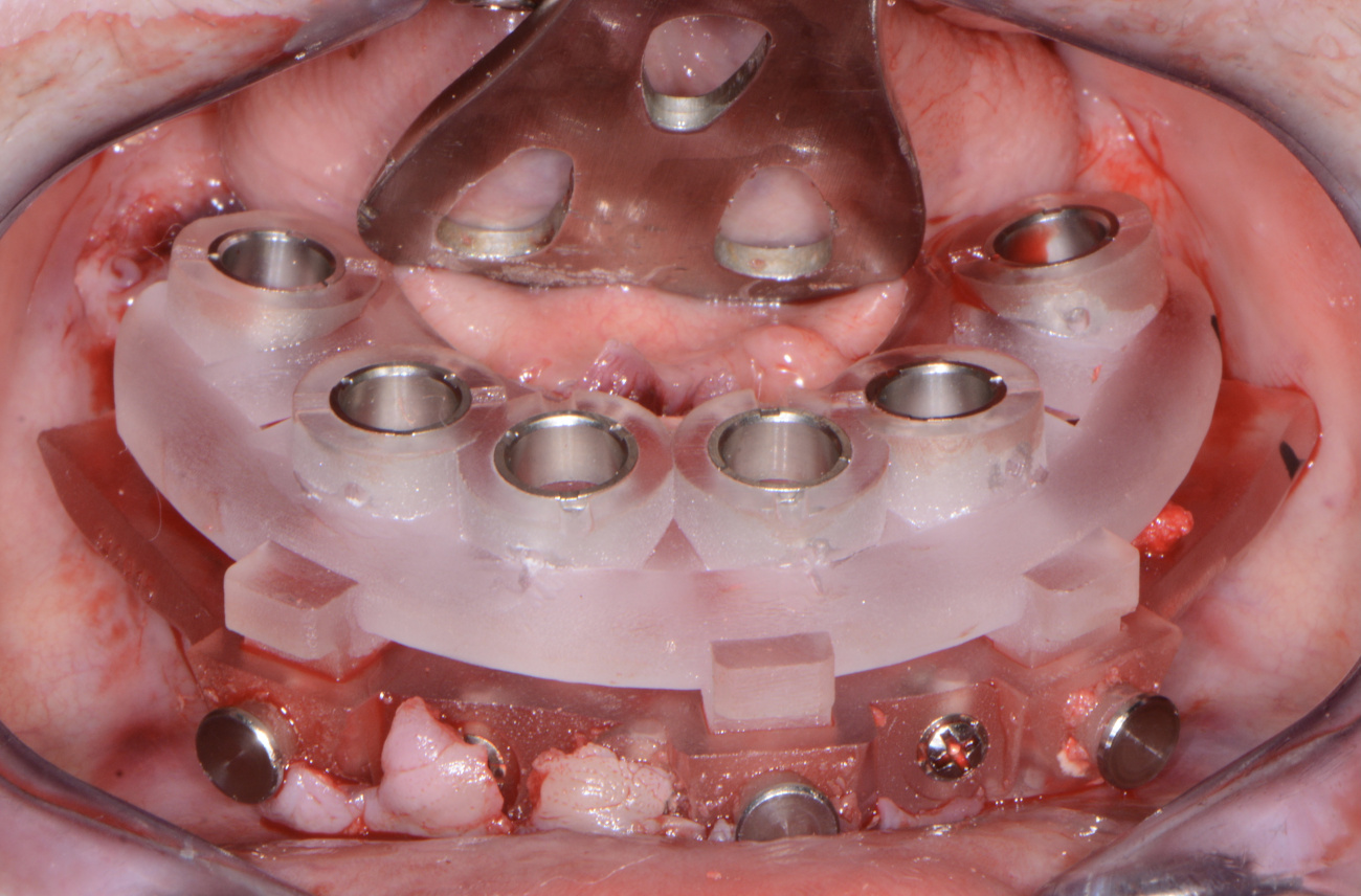 Dental News - Predictable immediate guided implant placement and ...