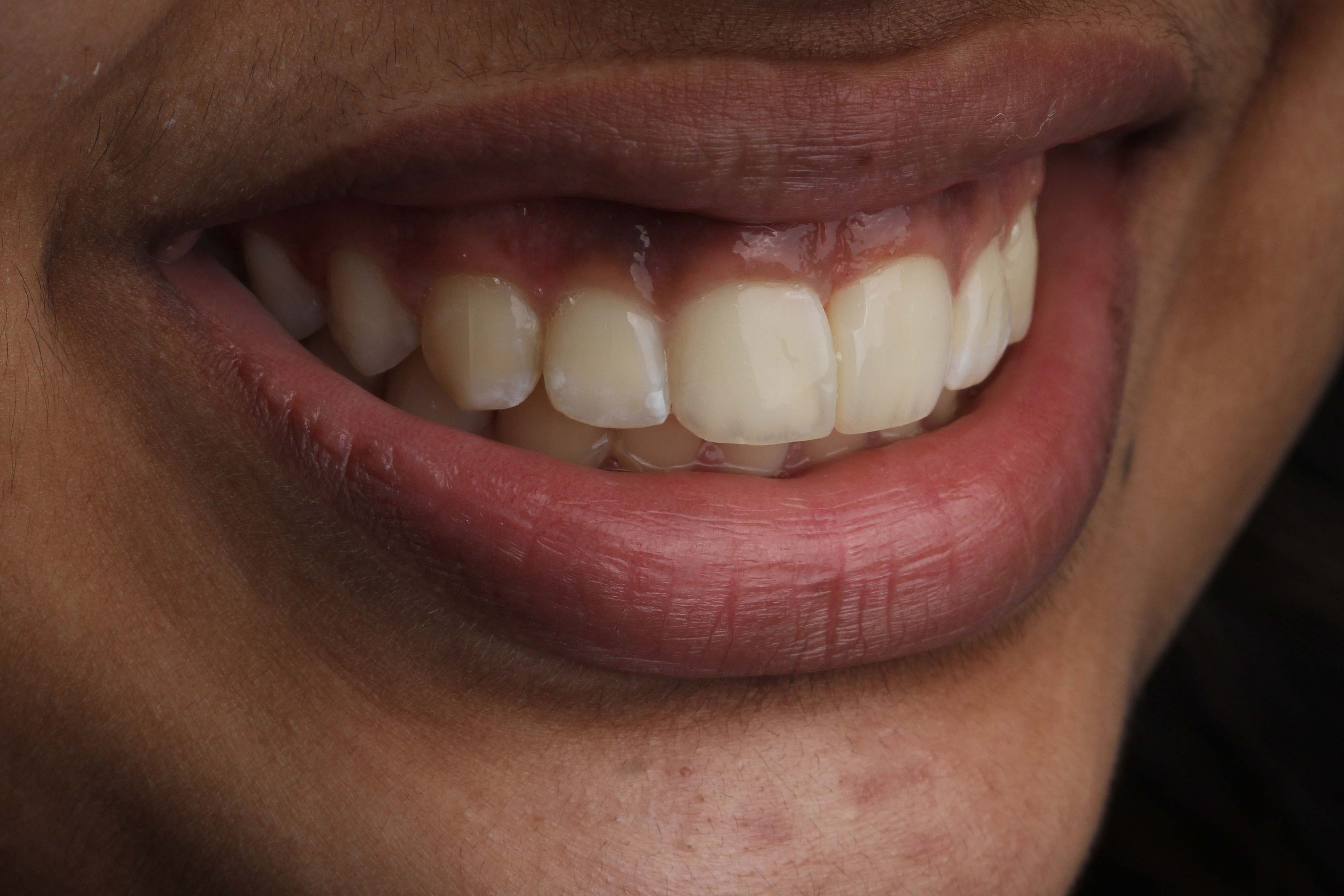 DT News - India - Front wing technique for direct diastema closures ...