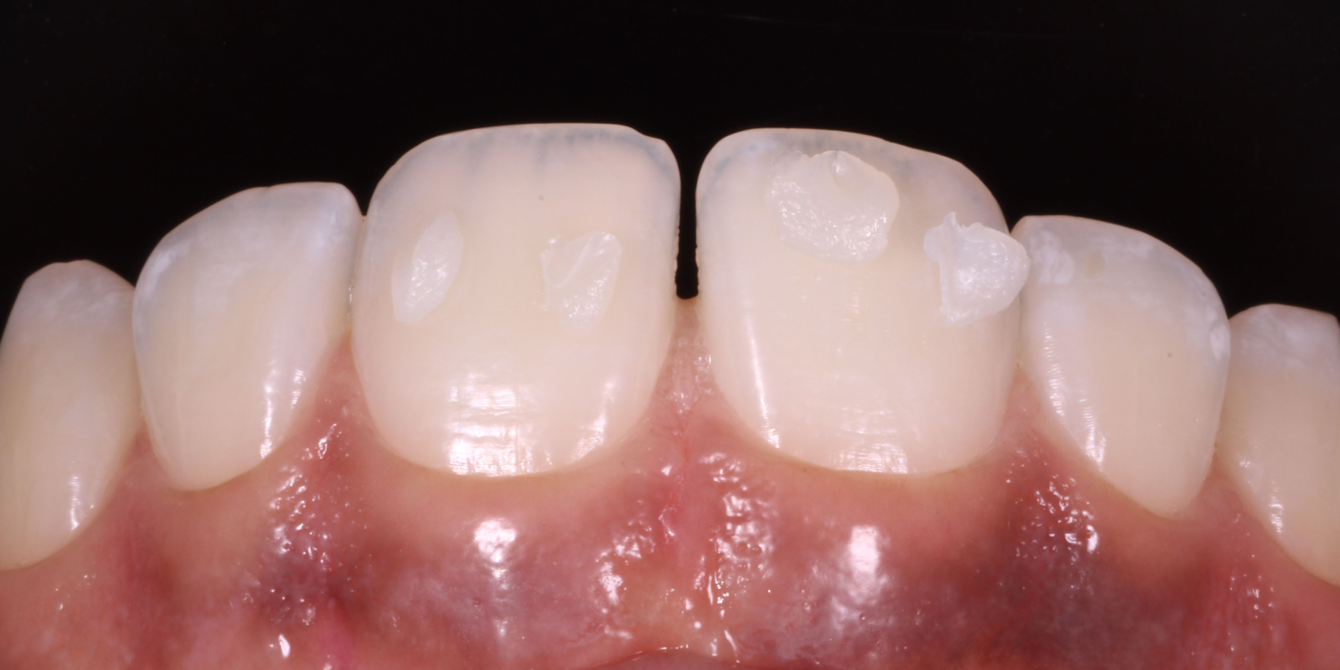 DT News - India - Front wing technique for direct diastema closures ...