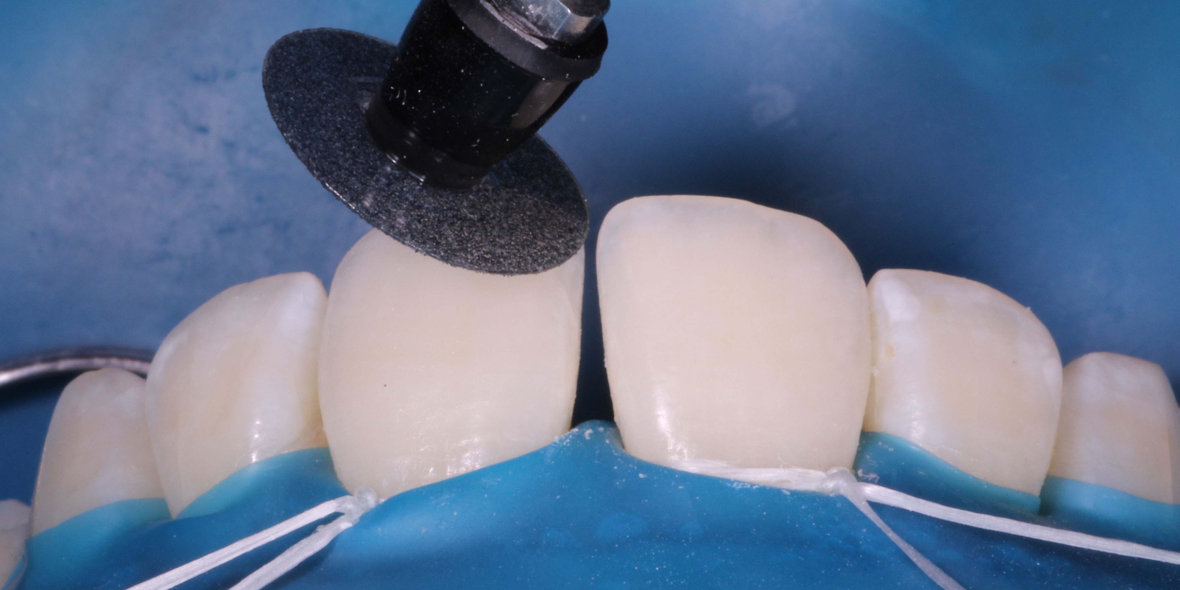 DT News - India - Front wing technique for direct diastema closures ...