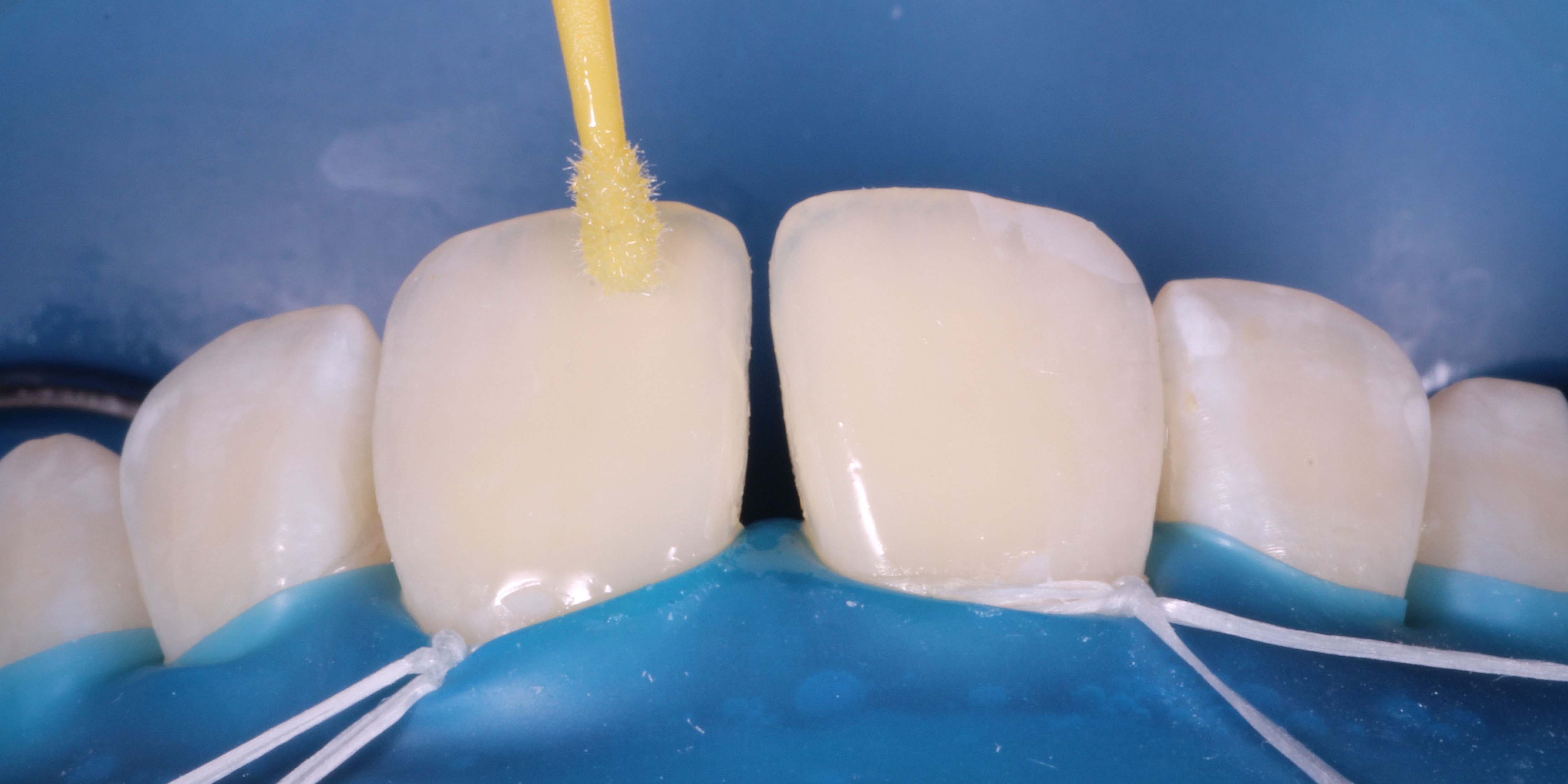 DT News - India - Front wing technique for direct diastema closures ...