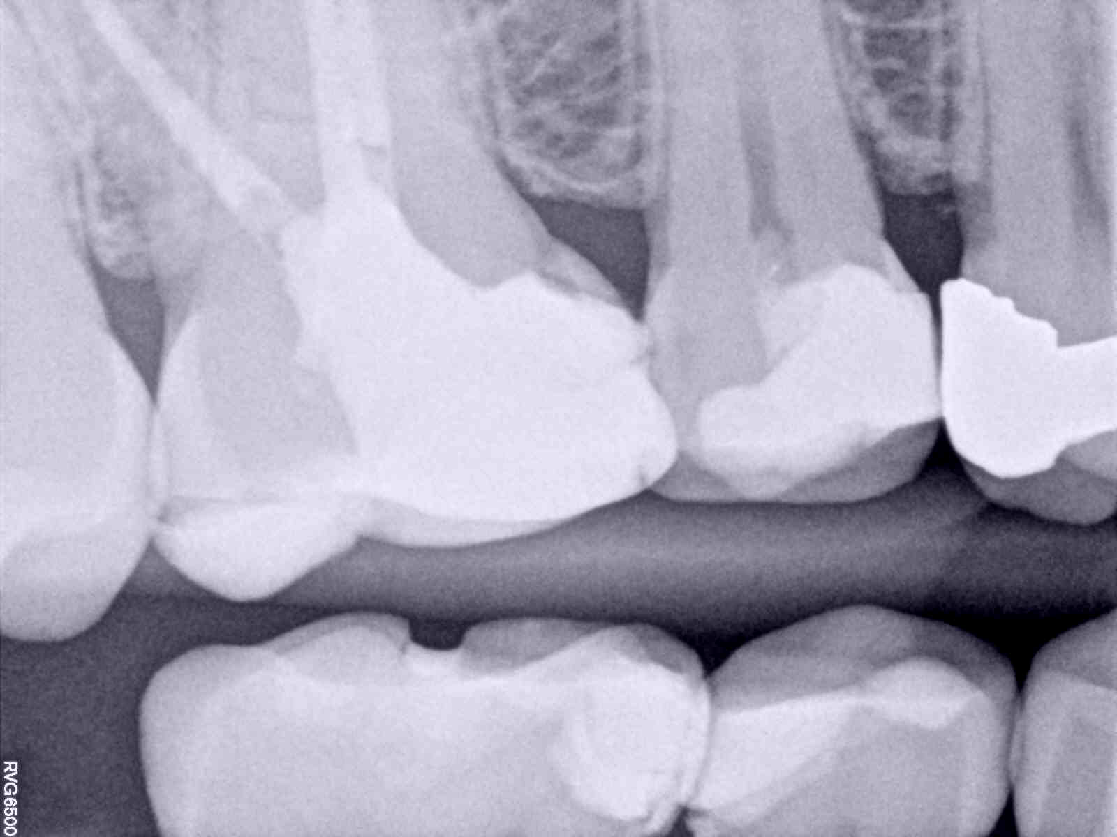 Dental News - Calcium silicate-based endodontic materials: A clinical ...