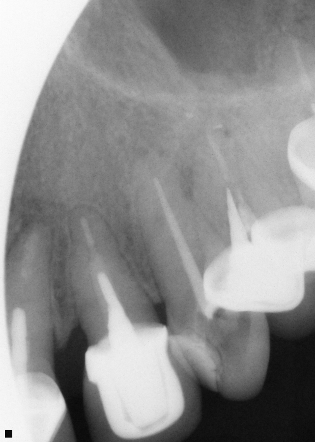 Dental News - Conservative restorative-driven endo: Preserving tooth ...