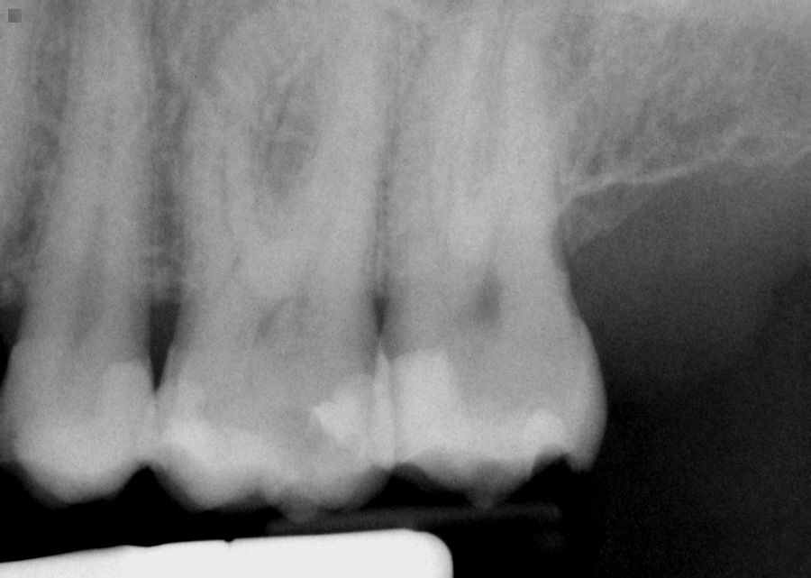 Dental News - Conservative restorative-driven endo: Preserving tooth ...