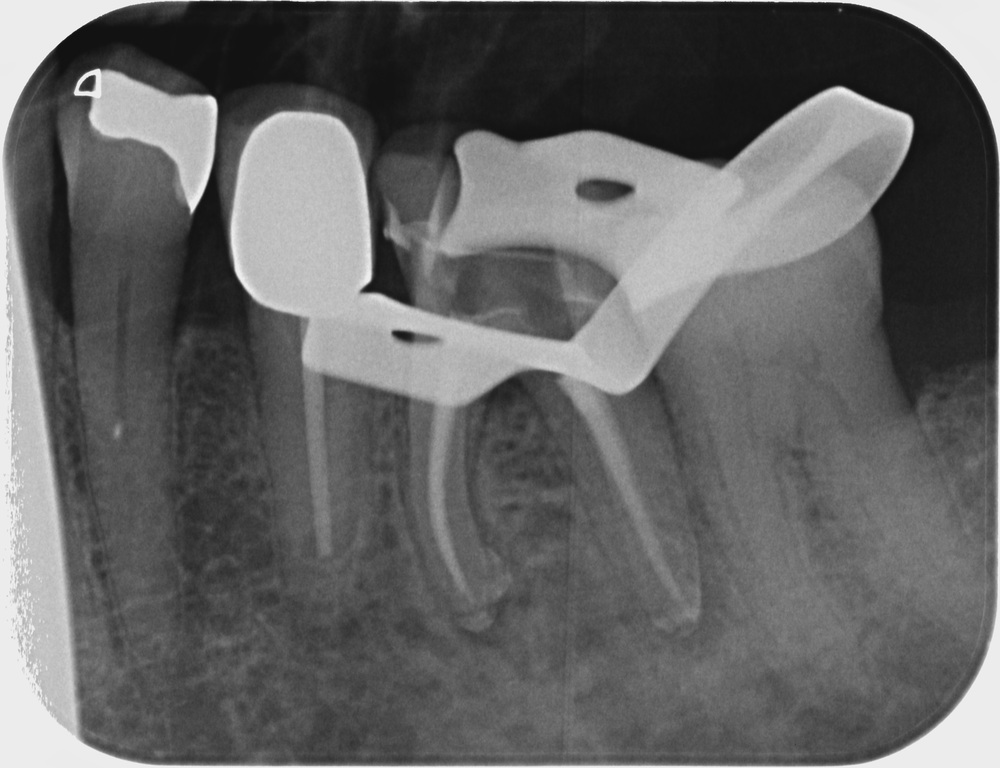 Dental News - Retreatment of a carrier-based root filling with ...