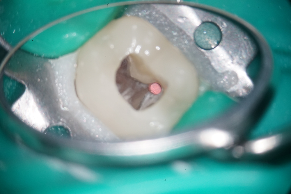 Dental News - Retreatment of a carrier-based root filling with ...