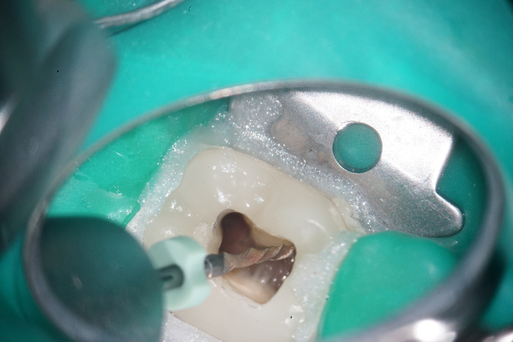 Dental News - Retreatment of a carrier-based root filling with ...