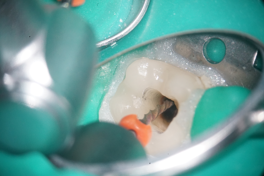 Dental News - Retreatment of a carrier-based root filling with ...
