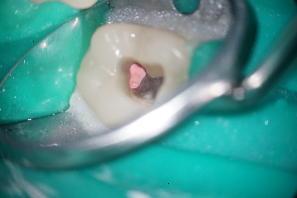 Dental News - Retreatment of a carrier-based root filling with ...
