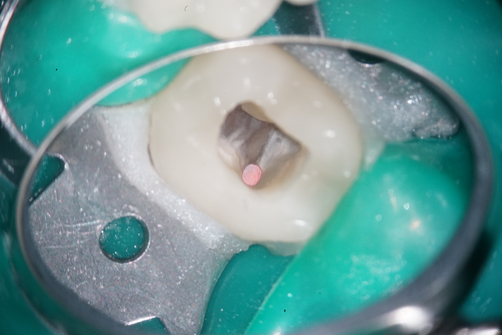 Dental News - Retreatment of a carrier-based root filling with ...