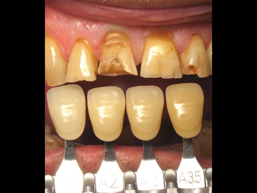 Dental News - Tenet : Time inversion applied to dentistry